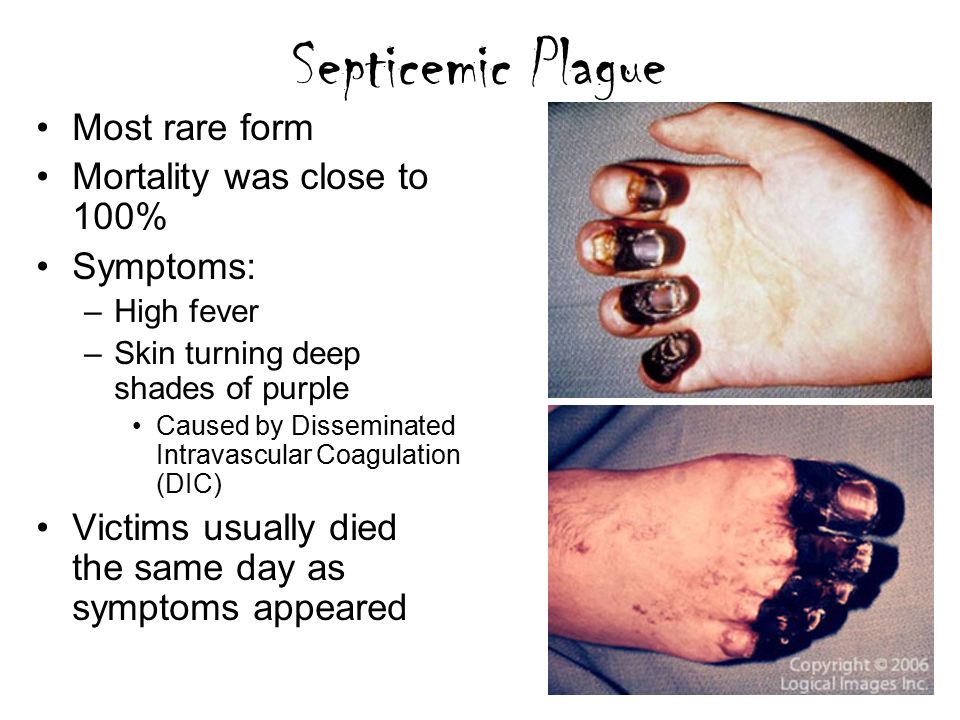 Bukan Nota Dinas : Penyakit Pes/ Sampar (Black Death)