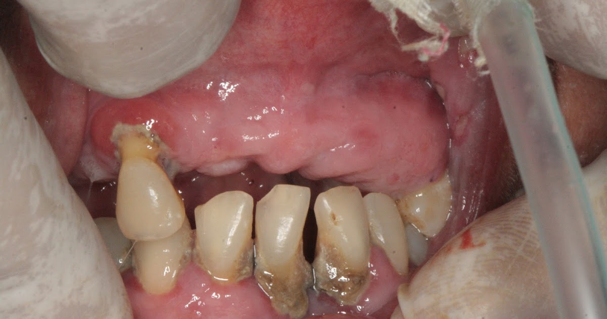 BIODONT - Moses Grimaldo Carjevschi, Odontólogo, Médico Bucal; Prótesis ...