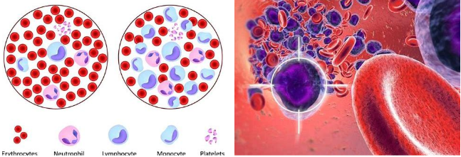 signs of leukemia | Blood CANCER: The Symptoms of leukemia