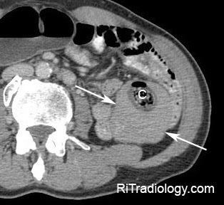 RiT radiology: Colonic Lymphoma
