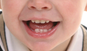 Chris M Jolley DDS: Double tooth