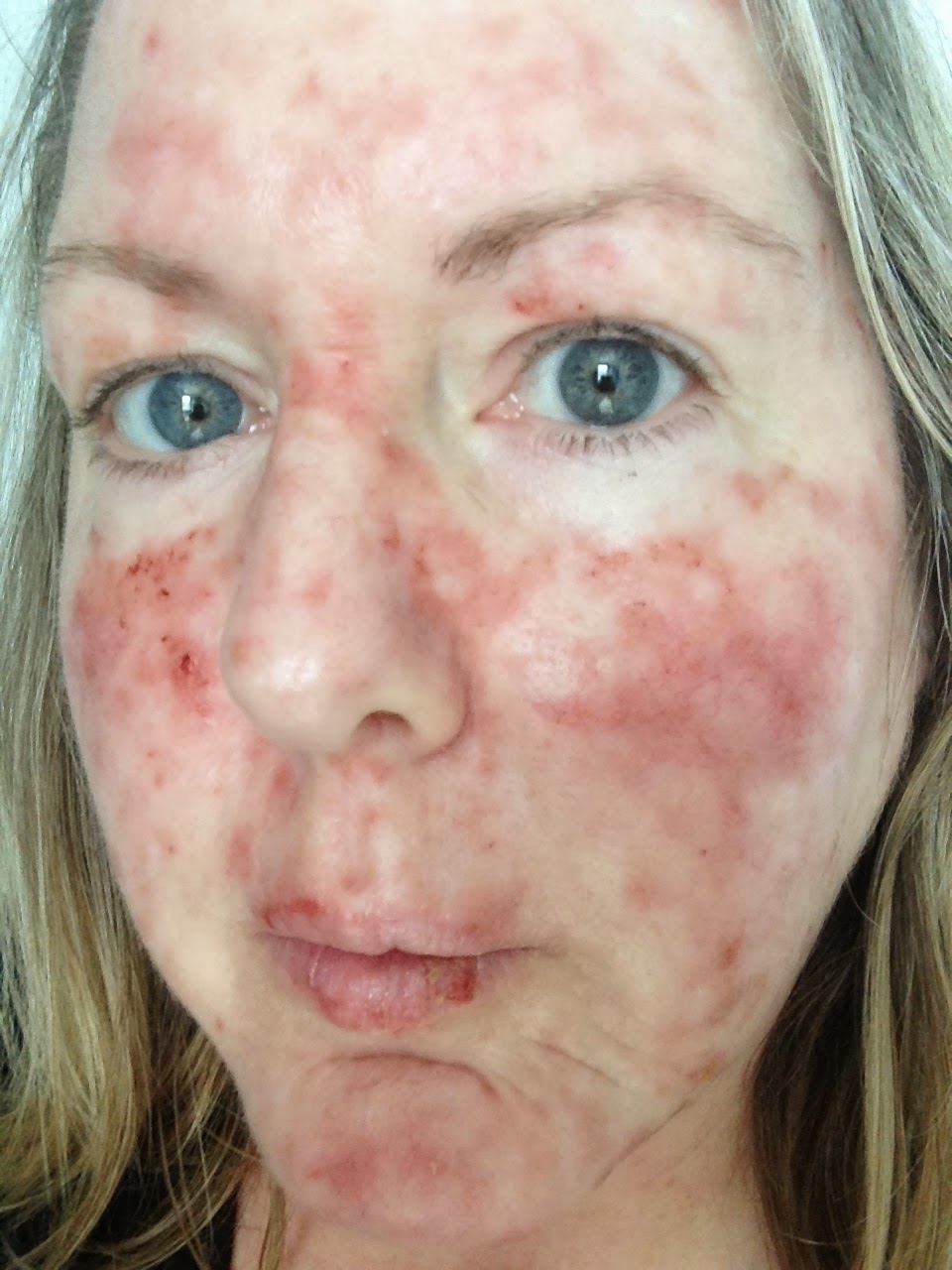 My Journey Through Topical Chemotherapy - Fluorouracil 5% Cream and ...