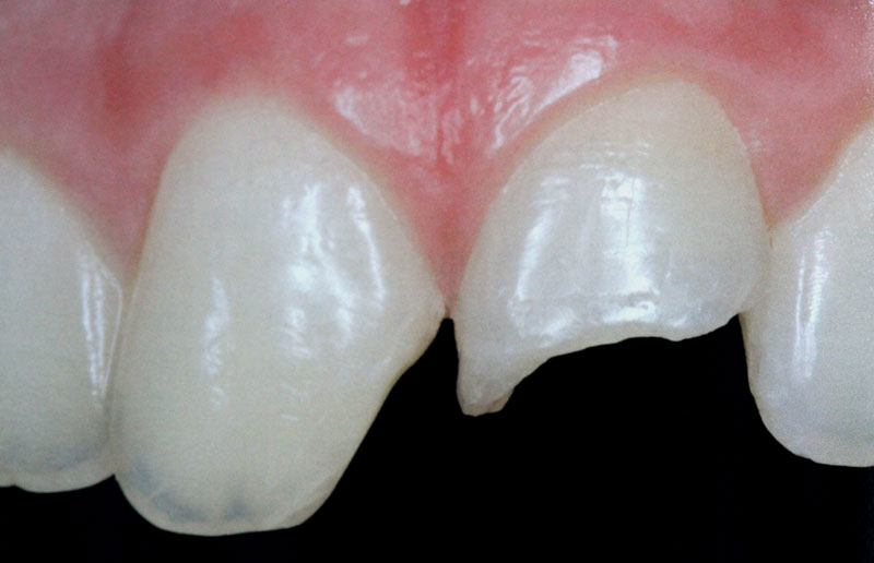 Meu dente quebrou! E agora? - Clínica Dr. Joel