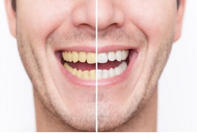 Petua Tips Cara Putihkan Gigi Kuning Dengan Berkesan Dan Mudah | Hub ...