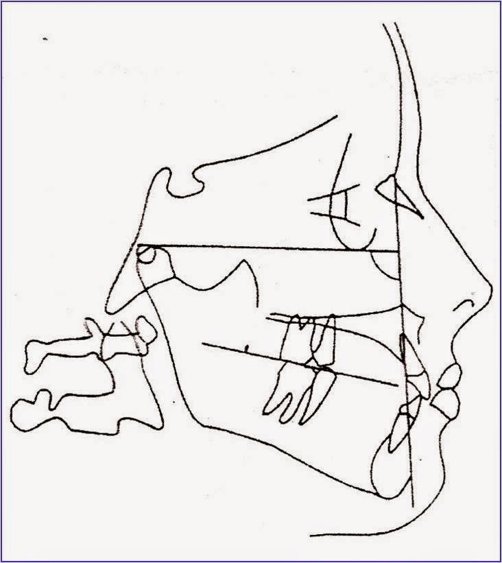 Tareas de Odontología : ANALISIS DE DOWNS