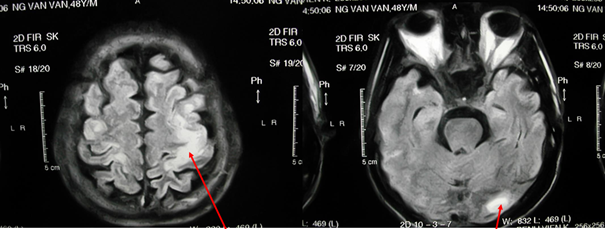 học Y: hội chứng tăng áp lực nội sọ