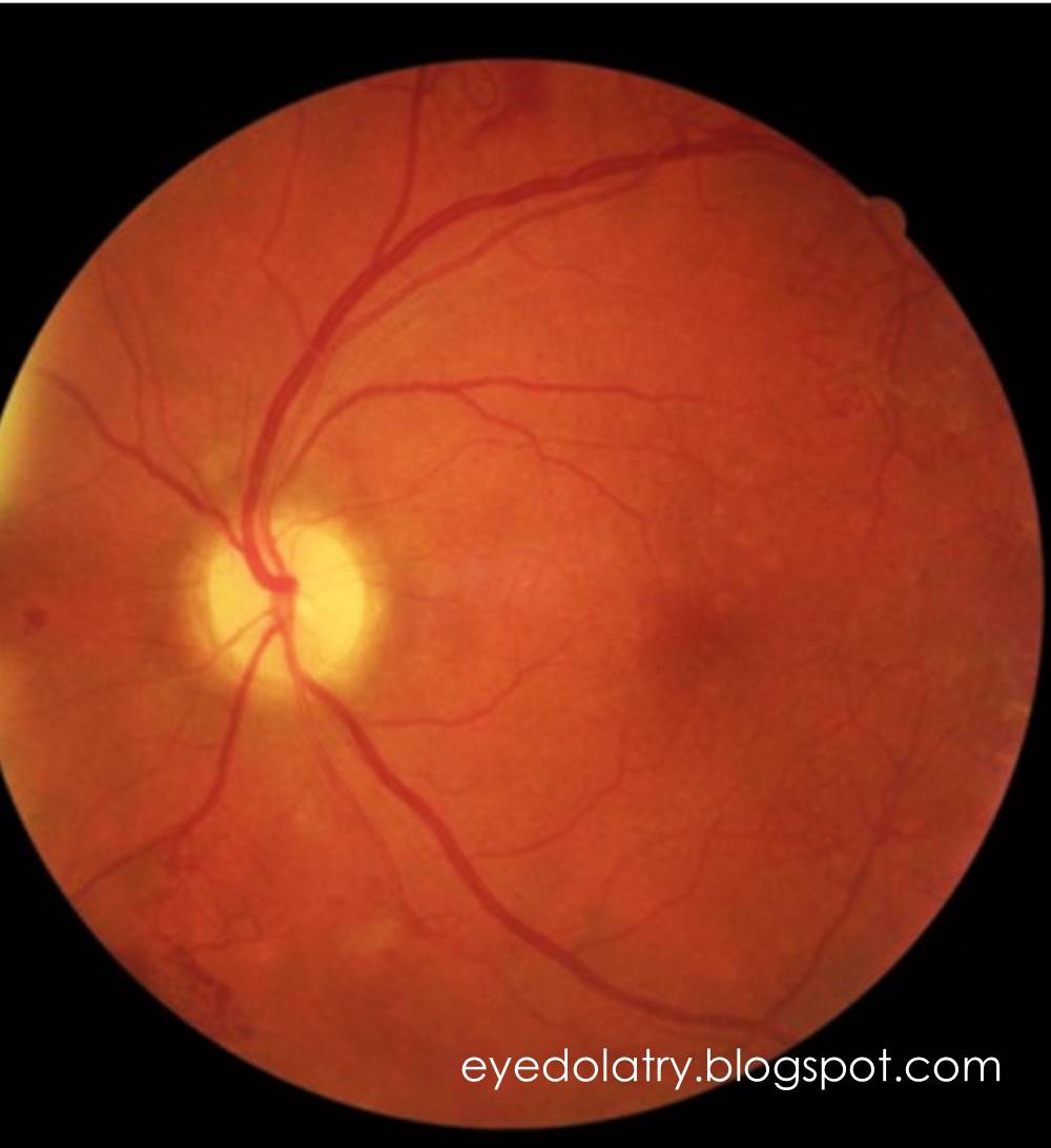 Picture Review of Diabetic Retinopathy - Eyedolatry