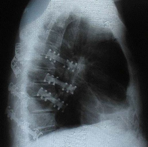 Revision Casos De Cirugia General: TORAX INESTABLE O TORAX FLOTANTE: