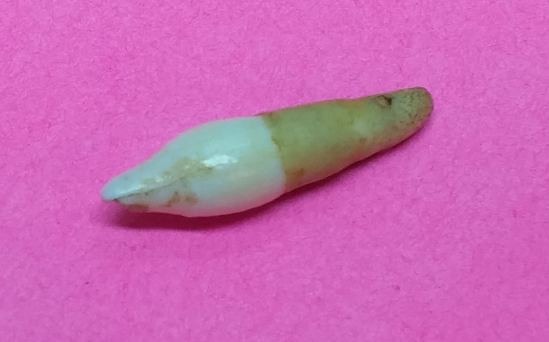 Exploriment: Conical Supernumerary Tooth