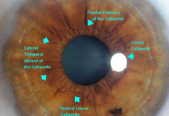Modern & Multidimensional Iridology: Lipemic Diathesis, Hypertrophy ...