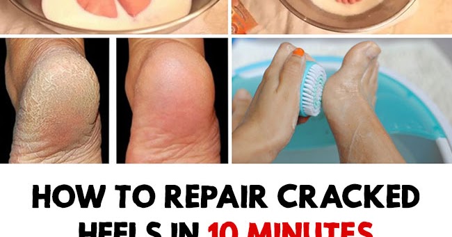 How to repair cracked heels in 10 minutes