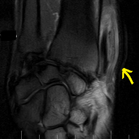 Dequervain’s Tenosynovitis-MRI - Sumer's Radiology Blog
