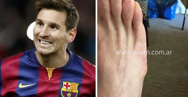 Así luce el pie lastimado de Lionel Messi | Barcelona Vs Real Madrid