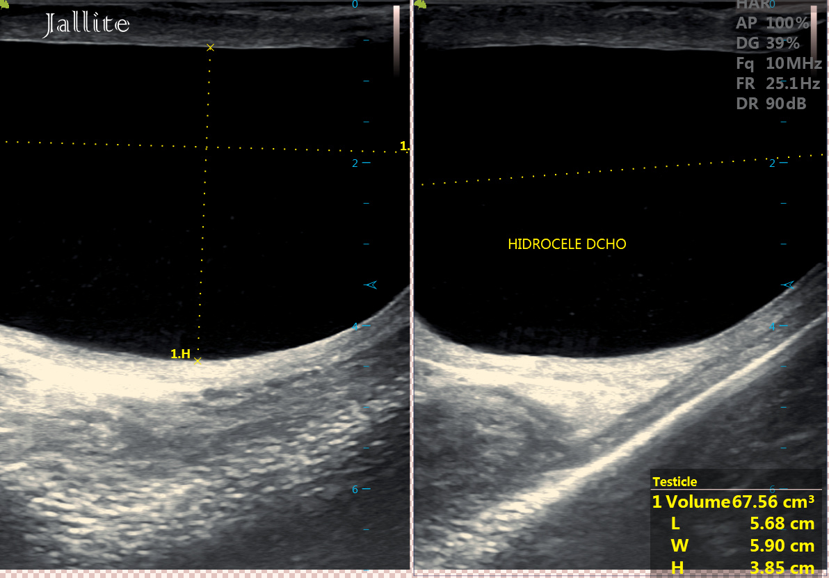 Hidrocele Post-Trauma