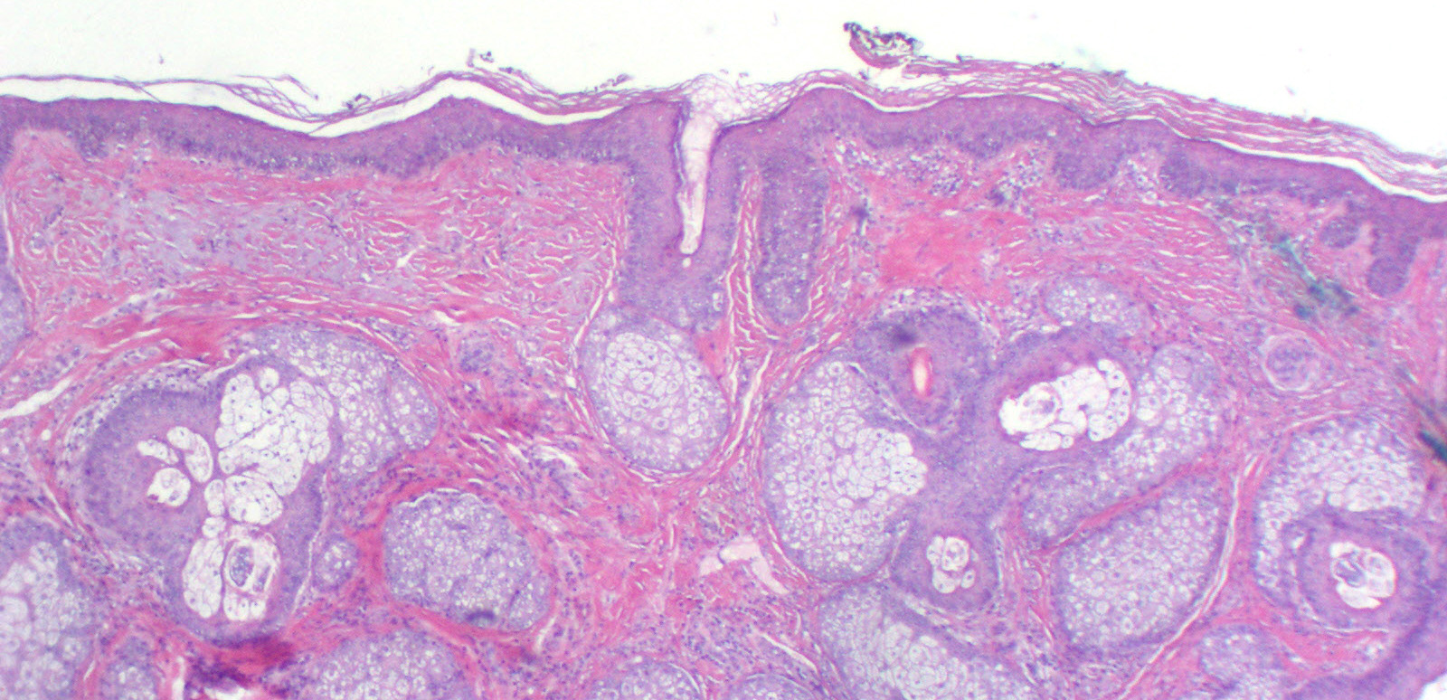 VIRTUAL GRAND ROUNDS IN DERMATOLOGY 2.0: Whose Nose Needs Mohs?