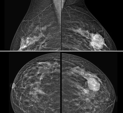 Case of fibroadenoma - Radiology Imaging