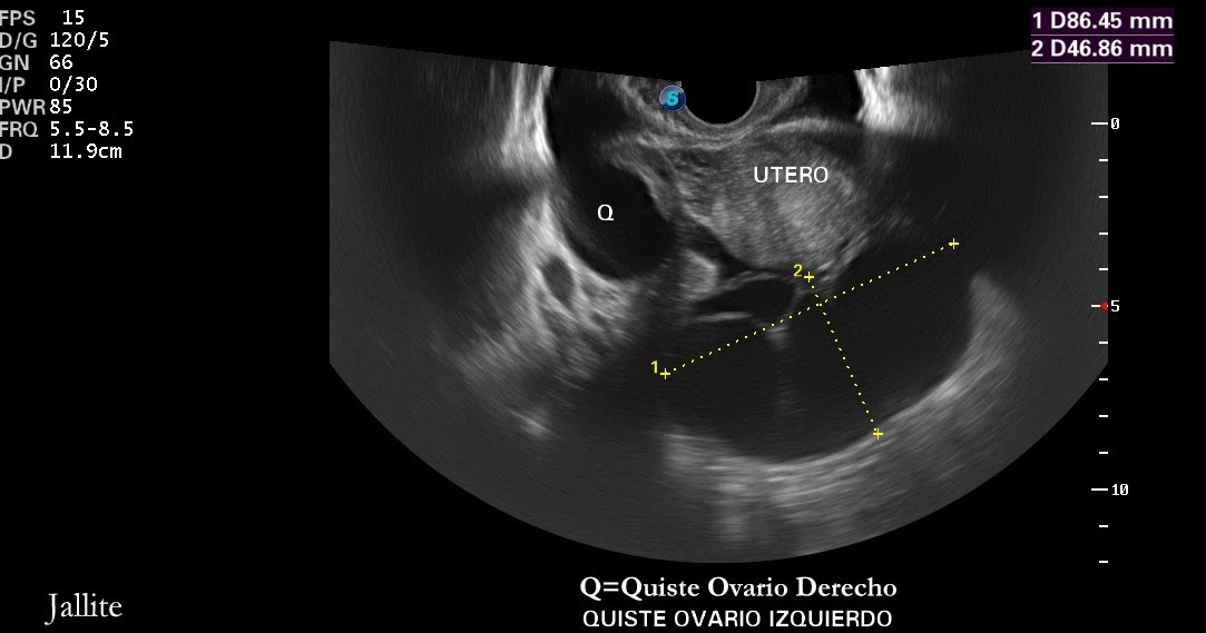 Quistes Ovaricos Bilaterales