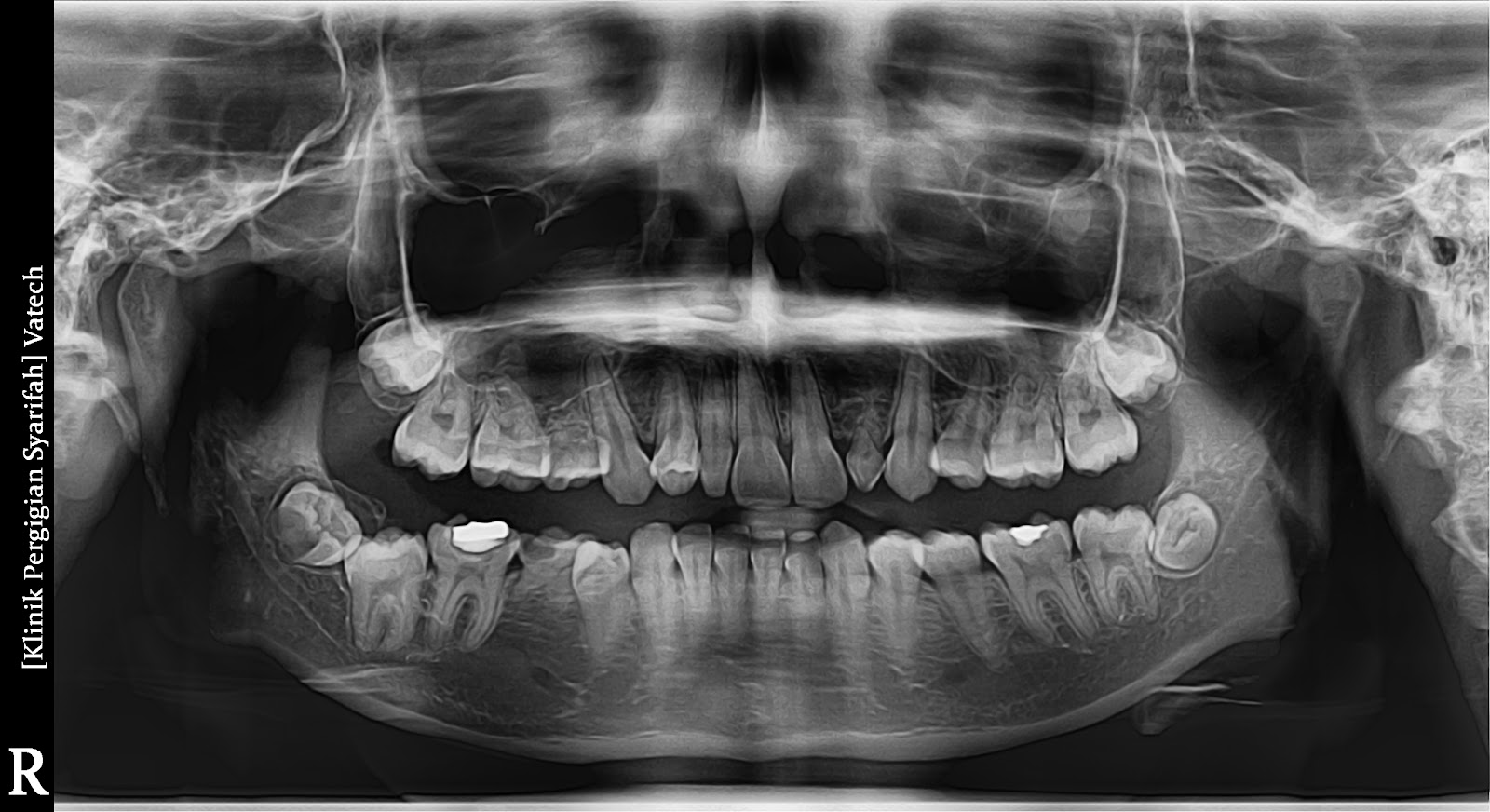 KLINIK PERGIGIAN SYARIFAH: OPG X-ray