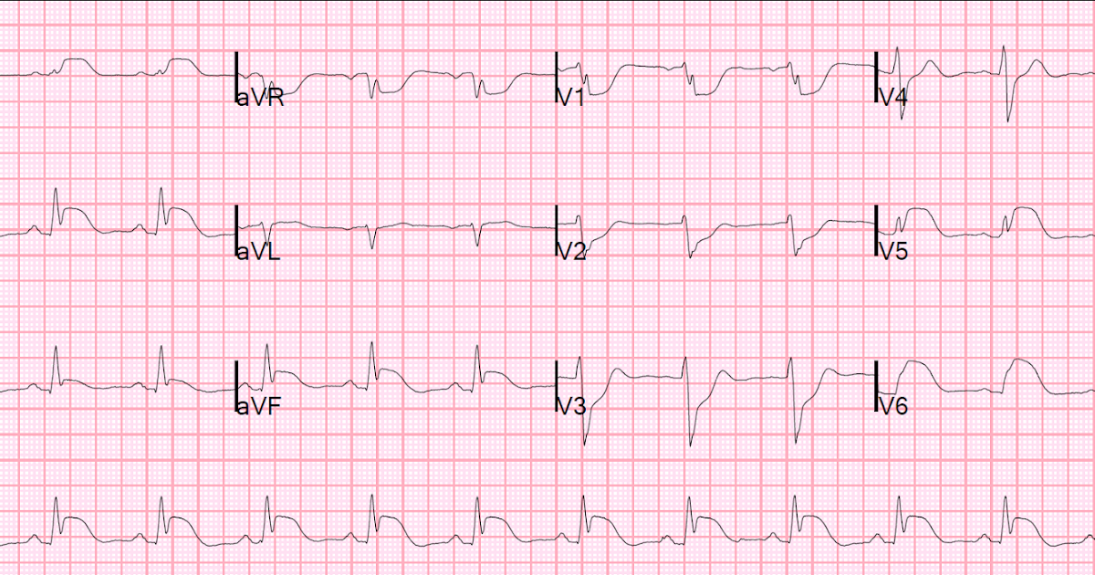 Dr. Smith's ECG Blog: A Perfect Resuscitation Saves a Patient with ...