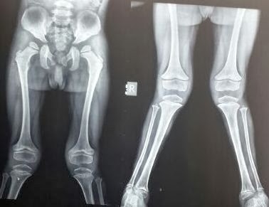 Mucopolysaccharidosis (MPS)-Xray Diagnosis - Sumer's Radiology Blog