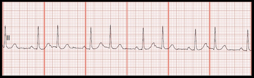EKG Rhythm Strip Quiz 152