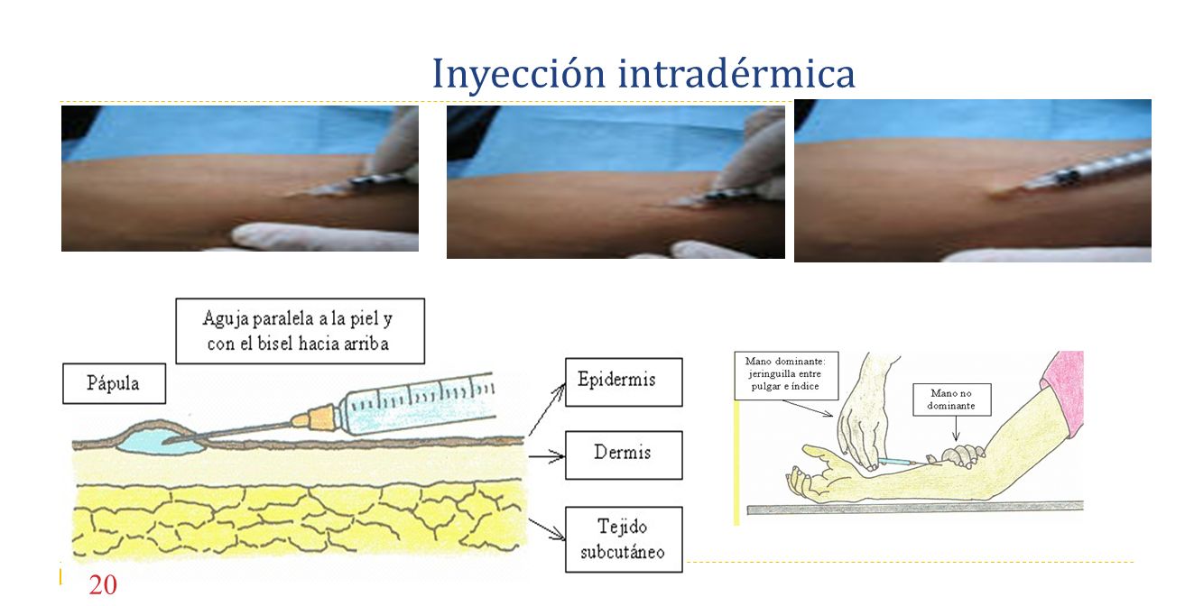 ADMINISTRACIÓN DE MEDICACIÓN: Vía intradérmica