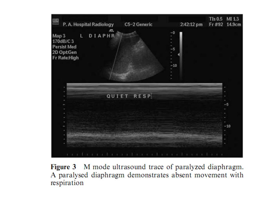 BÀI SOẠN VỀ SIÊU ÂM CHẨN ĐOÁN: DIAPHRAGMATIC PARALYSIS: M mode US and ...
