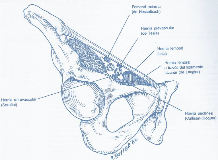 DR. JUAN HERNÁNDEZ ORDUÑA. : Hernia inguinal y crural. Generalidades