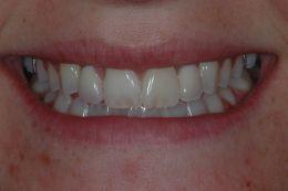 Dental flipper choices - What are your options? What's cost?