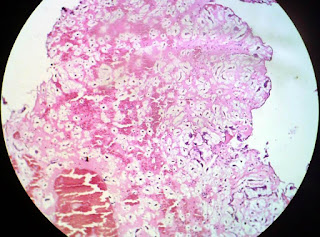DESTINO MEDICO: MICROSCOPIO VIRTUAL, PATOLOGIA CARDIACA - MIXOMA