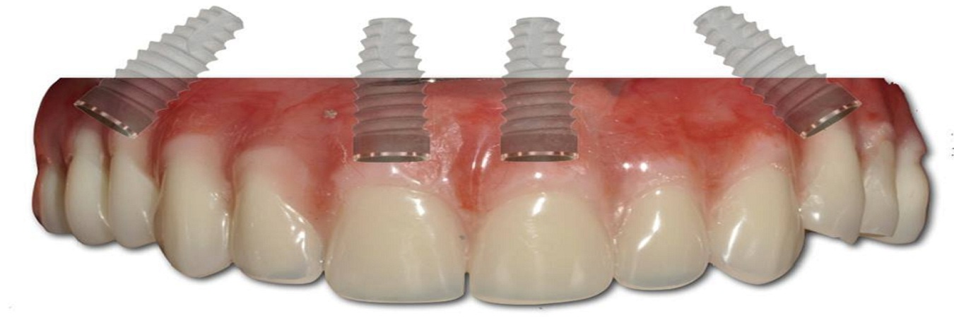Cost of all on four dental implants in india: All on 4 implants ...
