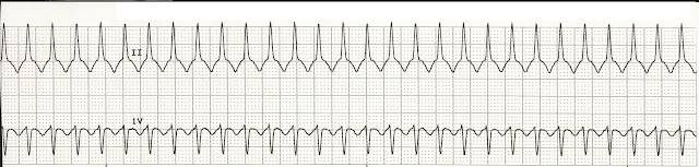 Pediatric Advance Life Support: SVT Part 1