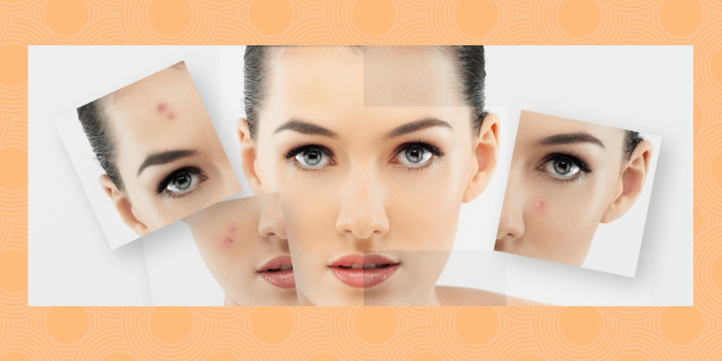 Sebum Control: Pros and Cons of Oral Medical Therapy