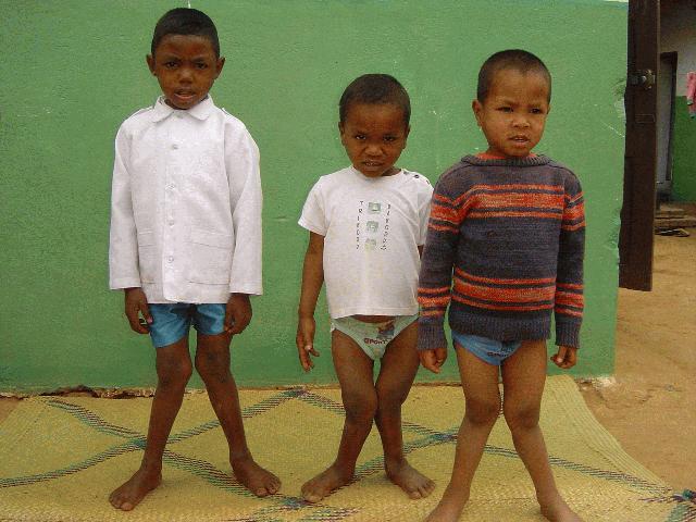 Rachitis : Symptome Ursachen und Abhilfen