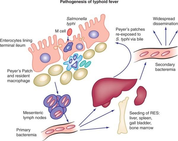 Diagnosis And Complications Of Typhoid - Fastalobos