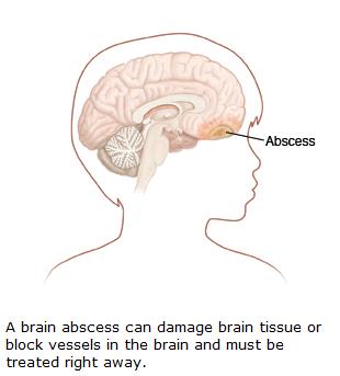 Pediatrics Notes: Brain Abscess In Children