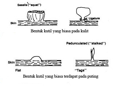 Cara Menghilangkan Kutil secara Alami: Cara Menghilangkan Kutil secara ...
