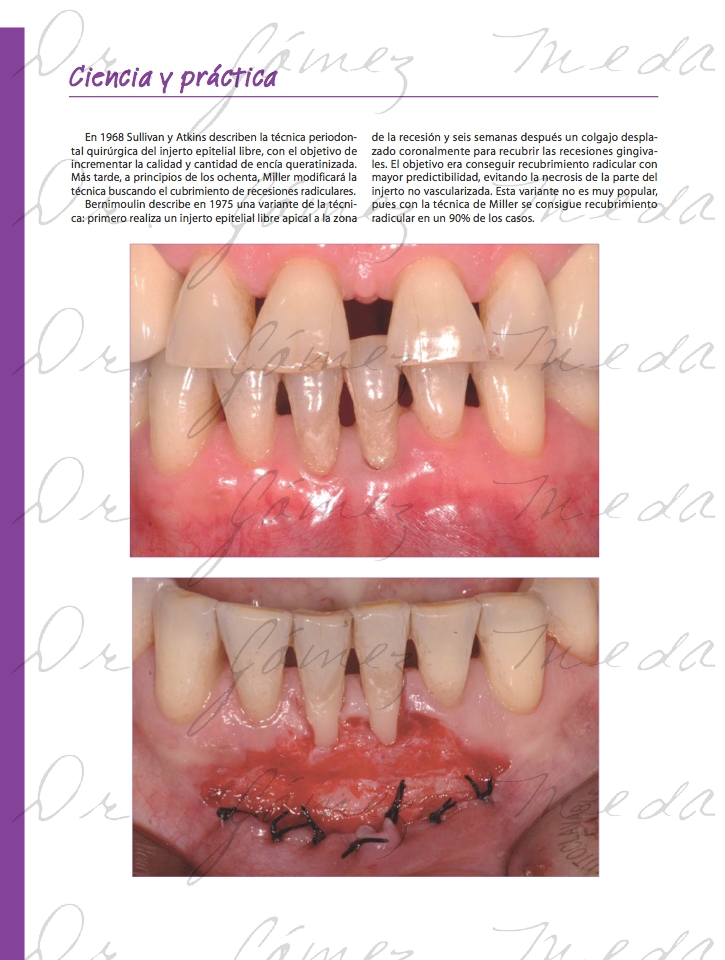 Dr.Meda: Injerto Epitelial Libre: Control de la Estabilidad a Largo ...