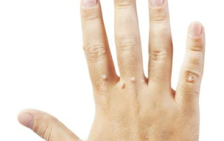 Kako Liječiti: Kako skinuti bradavice sa ruku i lica?