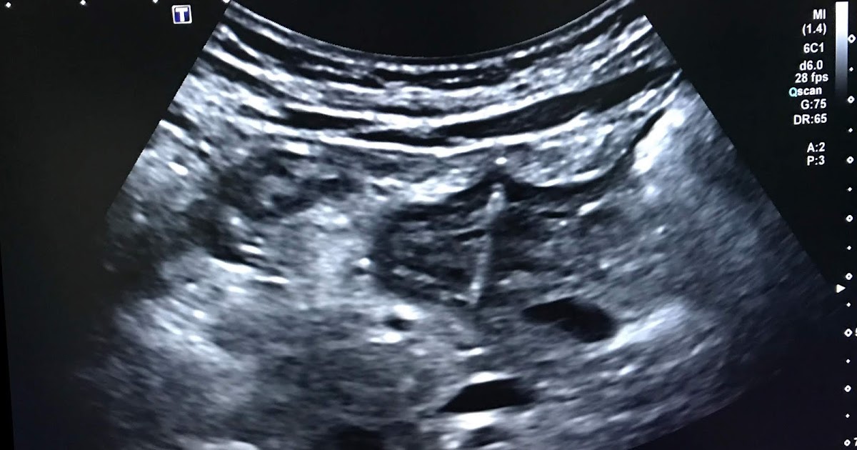 VIETNAMESE MEDIC ULTRASOUND: CASE 544: GASTRIC PERFORATION DUE TO ...