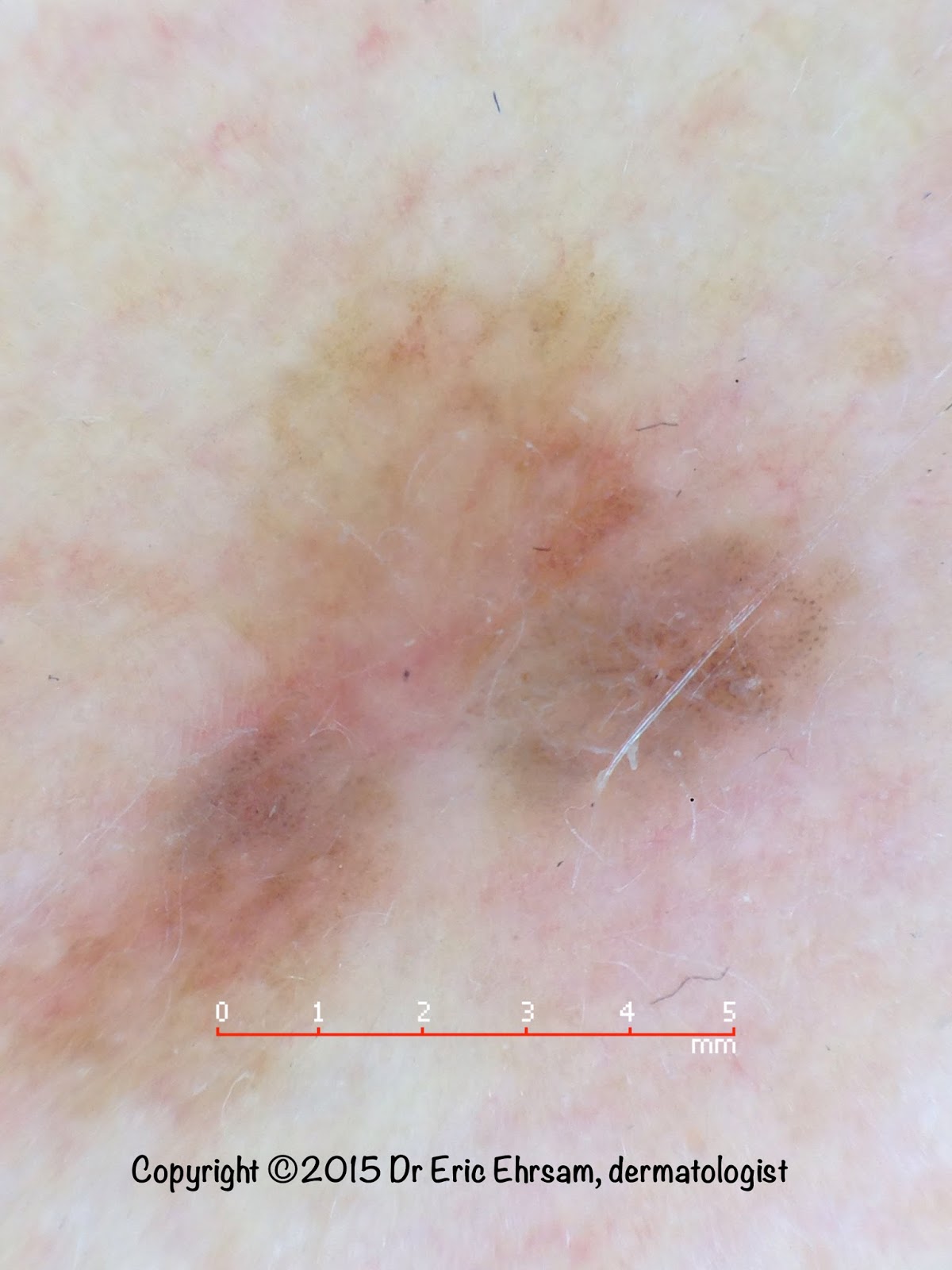 dermoscopy: Pigmented lesion on neck.