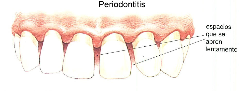 ENFERMEDAD PERIODONTAL