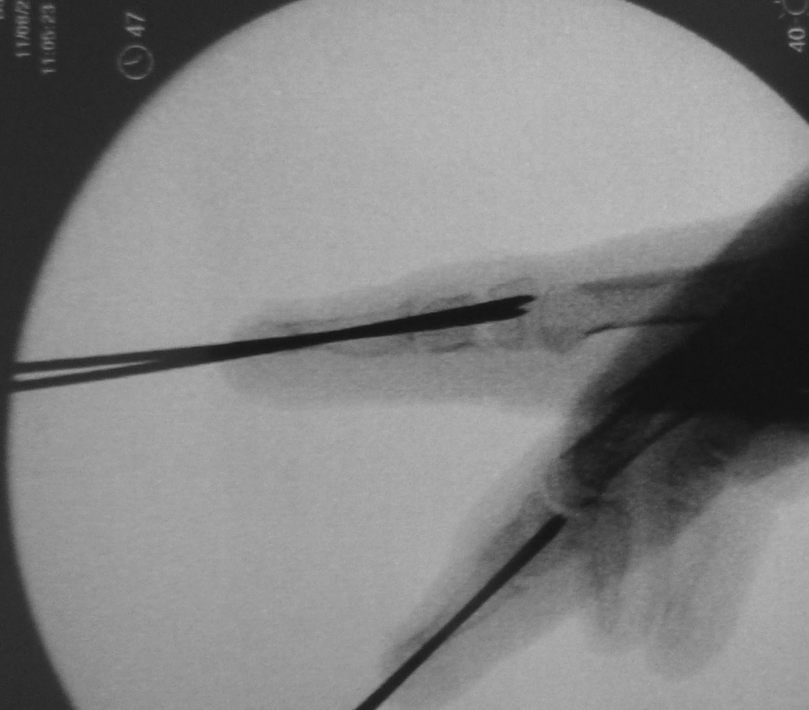 Carpenter Syndrome | Congenital Hand and Arm Differences | Washington ...