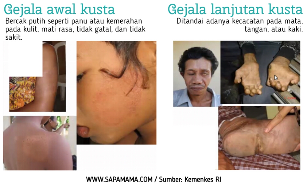 Apa Itu Kusta dan Bagaimana Pencegahan Serta Pengobatan Kusta?