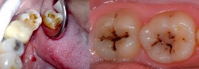 Karies Gigi Terjadi Karena?