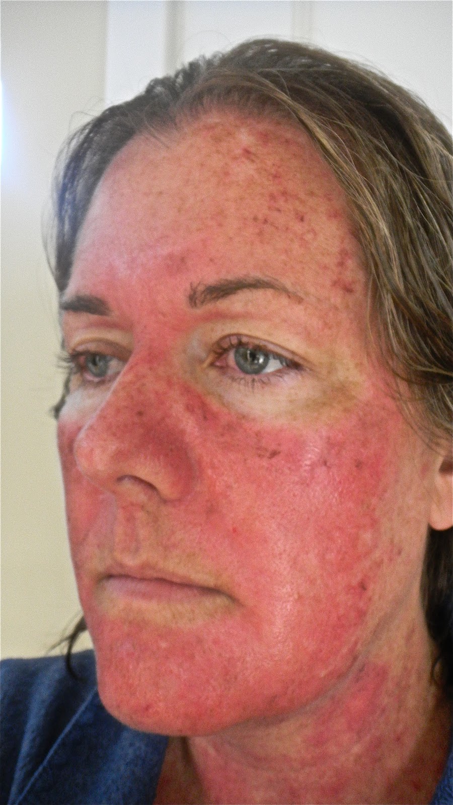 Efudex and Me 2013: Efudex Day Sixteen