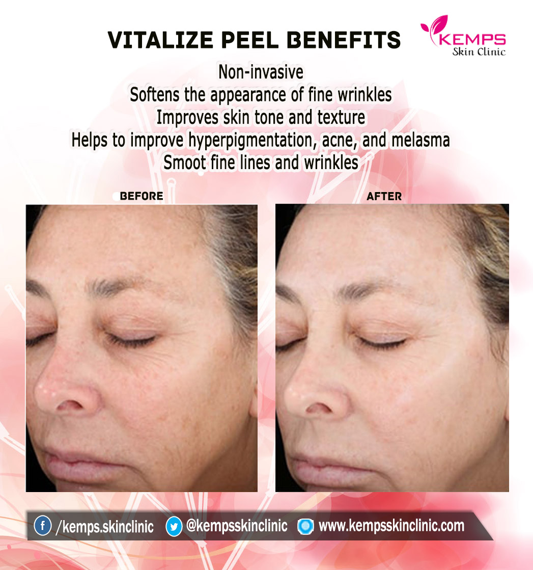 What is Vitalize peel? Know about it’s benefits and procedures | KEMPS ...