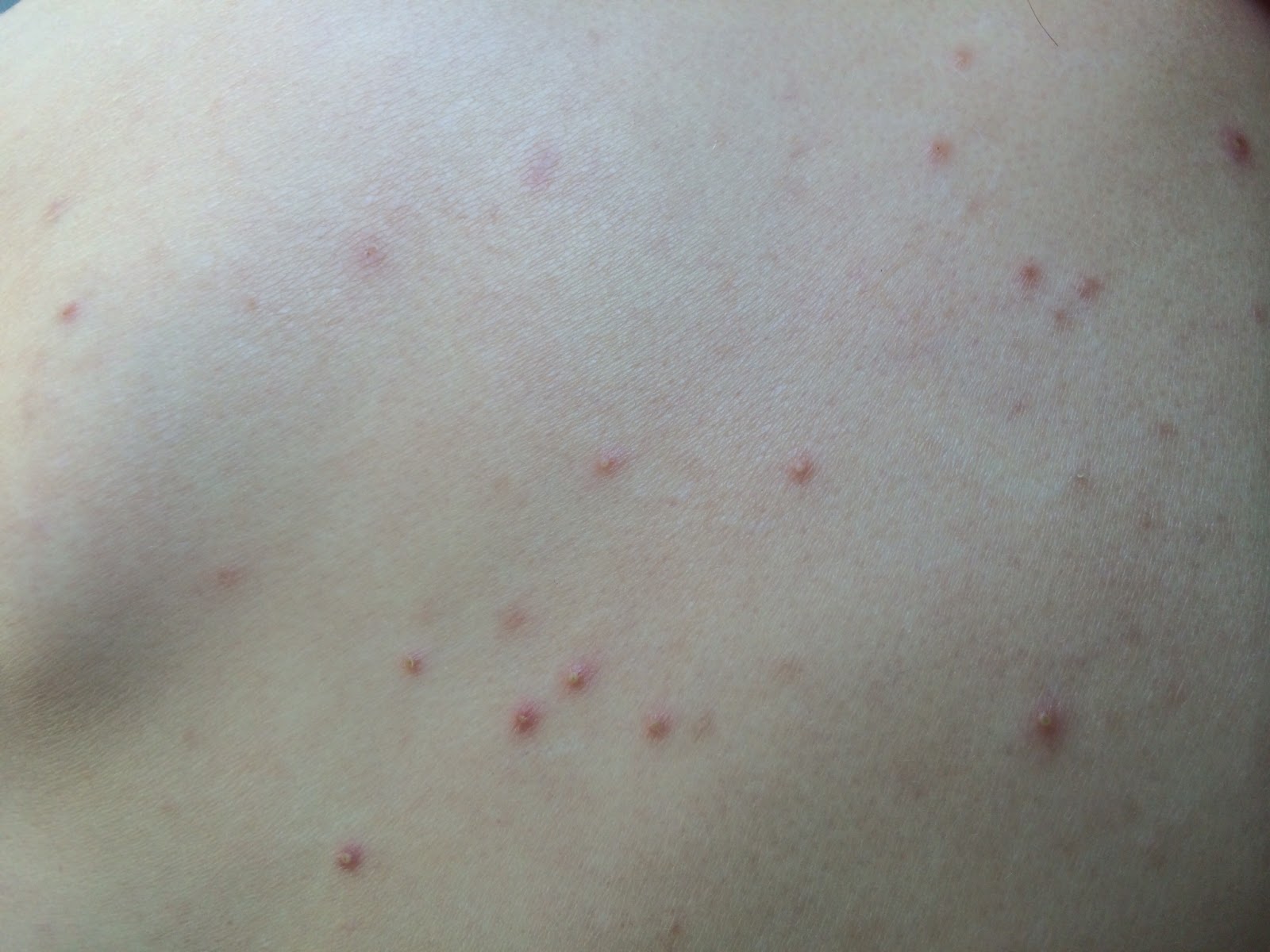 At Home With My BLT: The Day I Found Dr Richard Aron and Our Healing ...