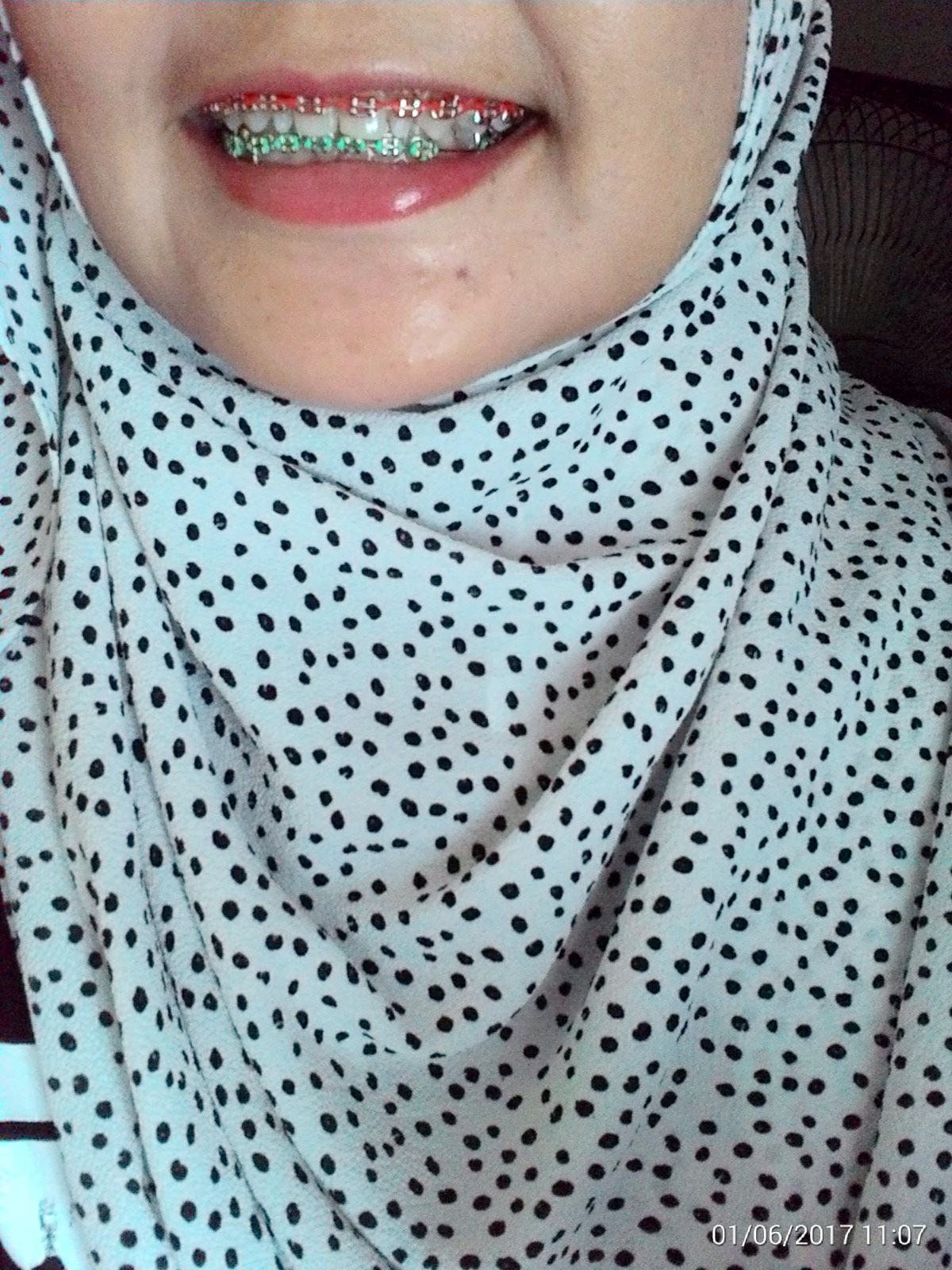 My Braces Elicy