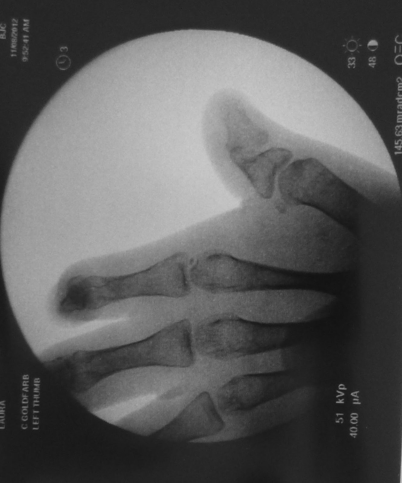 Carpenter Syndrome | Congenital Hand and Arm Differences | Washington ...